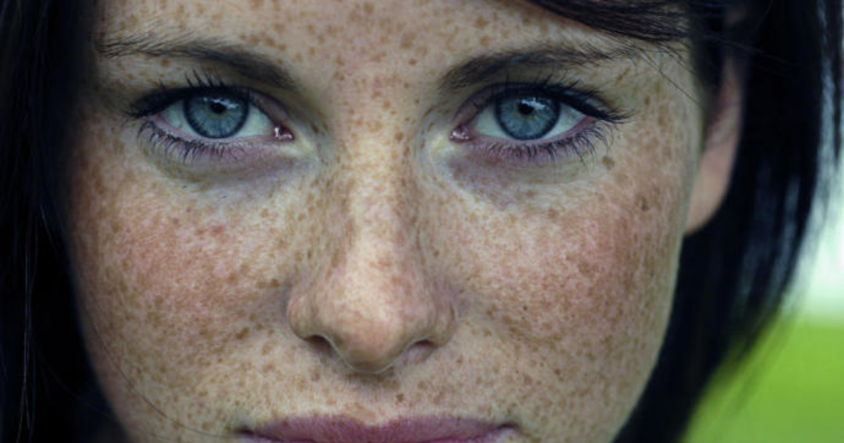 Do you find freckles on women/men attractive or disgusting? - GirlsAskGuys