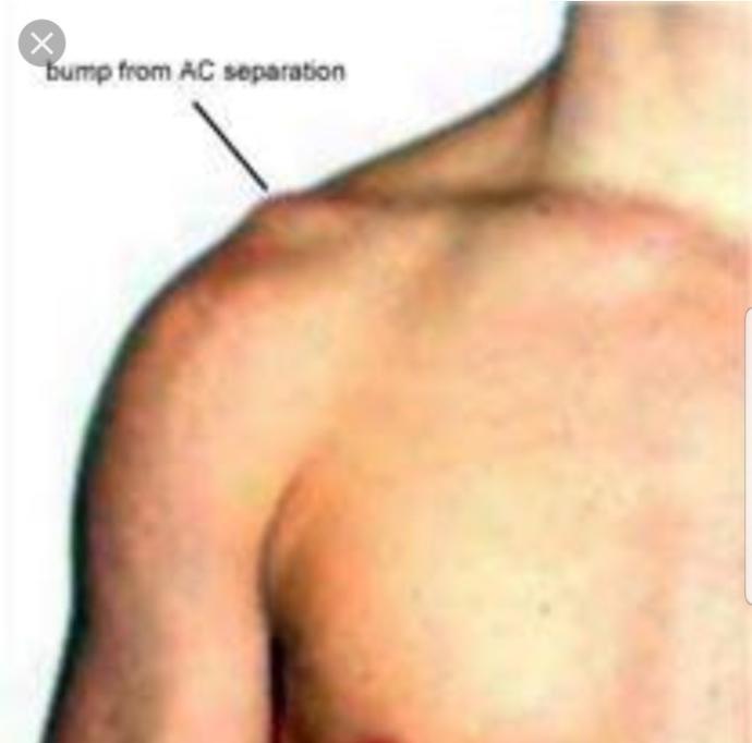 Does Anyone Else Have Bones On Shoulders That Stick Out Like This 