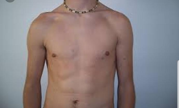 Does Anyone Else Have Bones On Shoulders That Stick Out Like This 