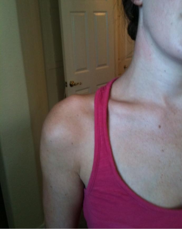 Does Anyone Else Have Bones On Shoulders That Stick Out Like This Does Anyone Else Have Bones On Shoulders That Stick Out Like This