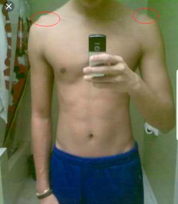 Does Anyone Else Have Bones On Shoulders That Stick Out Like This