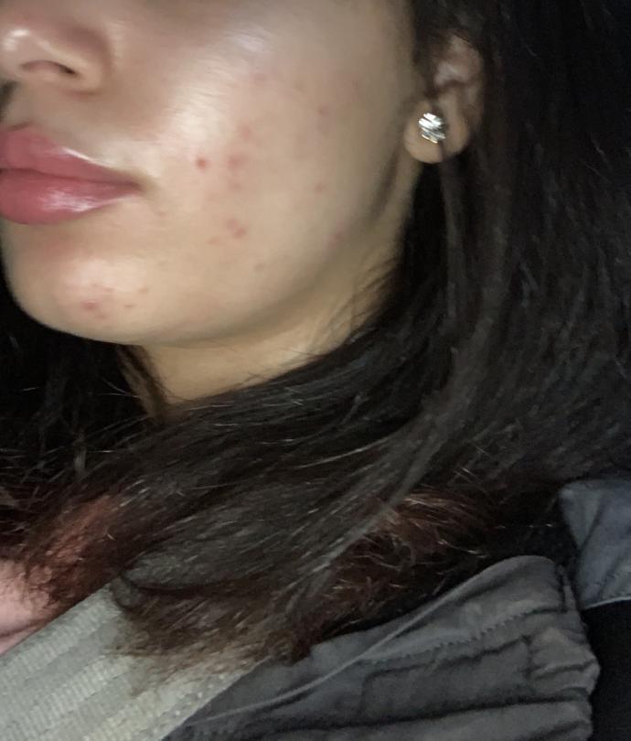 Is my acne really bad or am I overreacting? - GirlsAskGuys