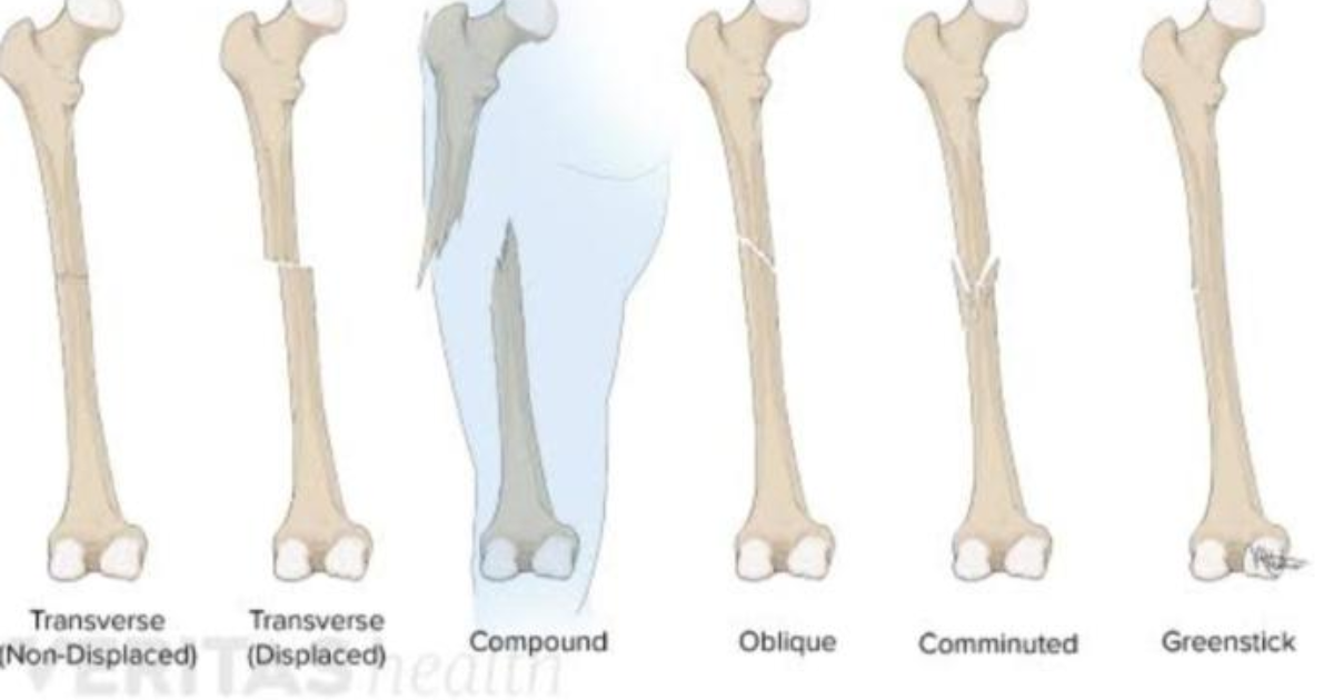 Does Broken Bones Got Stronger After It Heals GirlsAskGuys Does Broken Bones Got Stronger After It Heals GirlsAskGuys