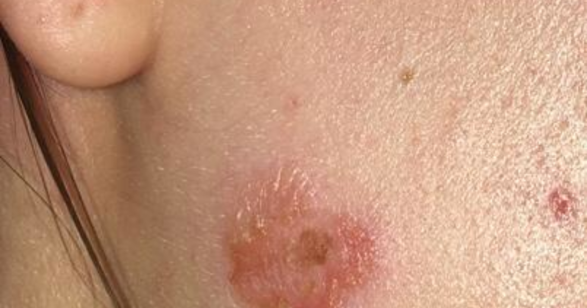 Circle of skin missing from my face skin, what is this? - GirlsAskGuys
