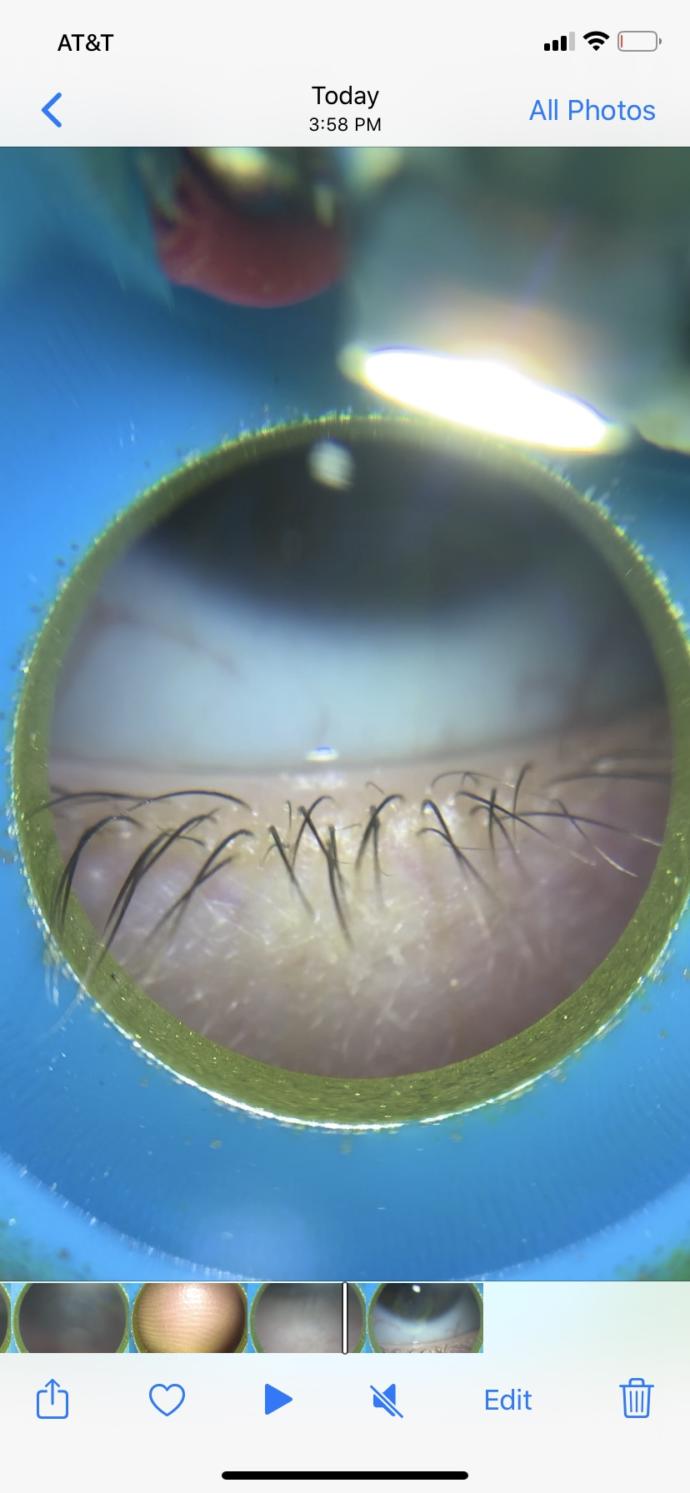 Do I have distichiasis? - GirlsAskGuys