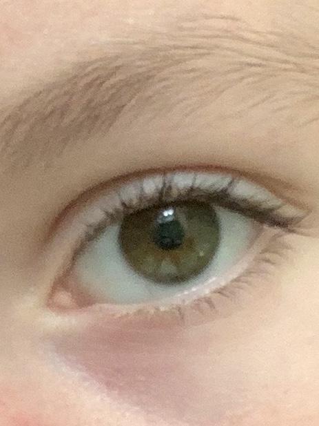 Do I have distichiasis? - GirlsAskGuys