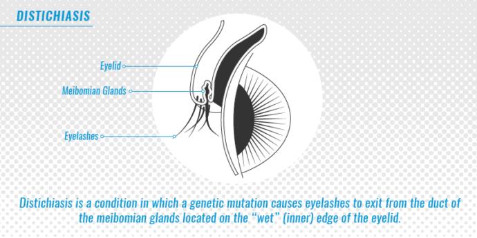 Do I have distichiasis? - GirlsAskGuys