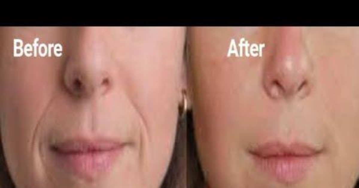 Should I get filler for my laugh lines or is it risky? Has anyone here ...