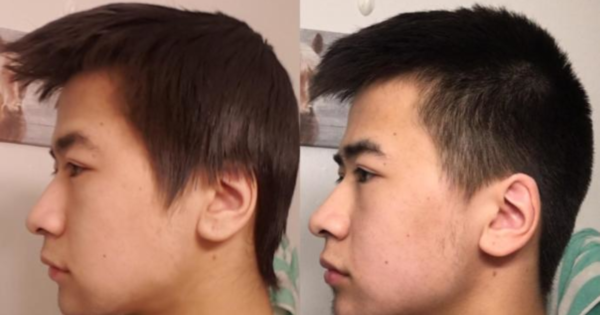 Does mewing actually work? - GirlsAskGuys