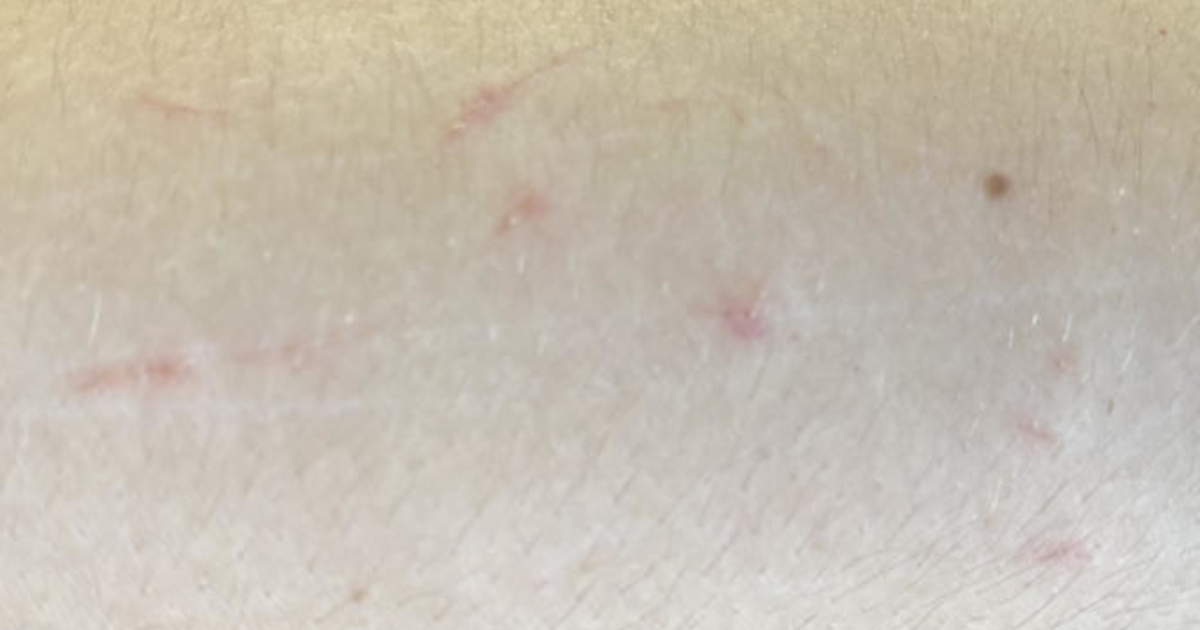 Any ideas on why random scratches are appearing on my arm? - GirlsAskGuys