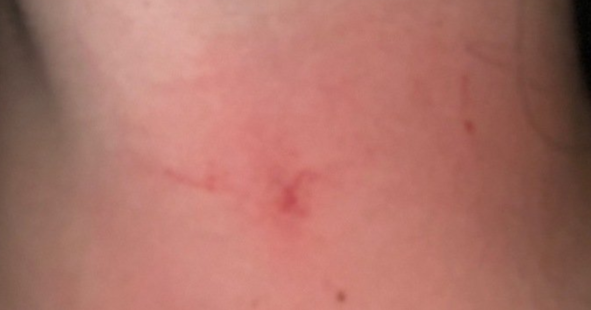 Guys, Is this a hickey? I’m talking with my ex again and he has a red ...