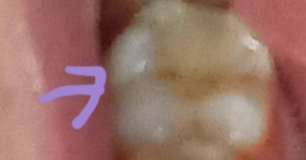 Is this stain on my filling or cavity? - GirlsAskGuys