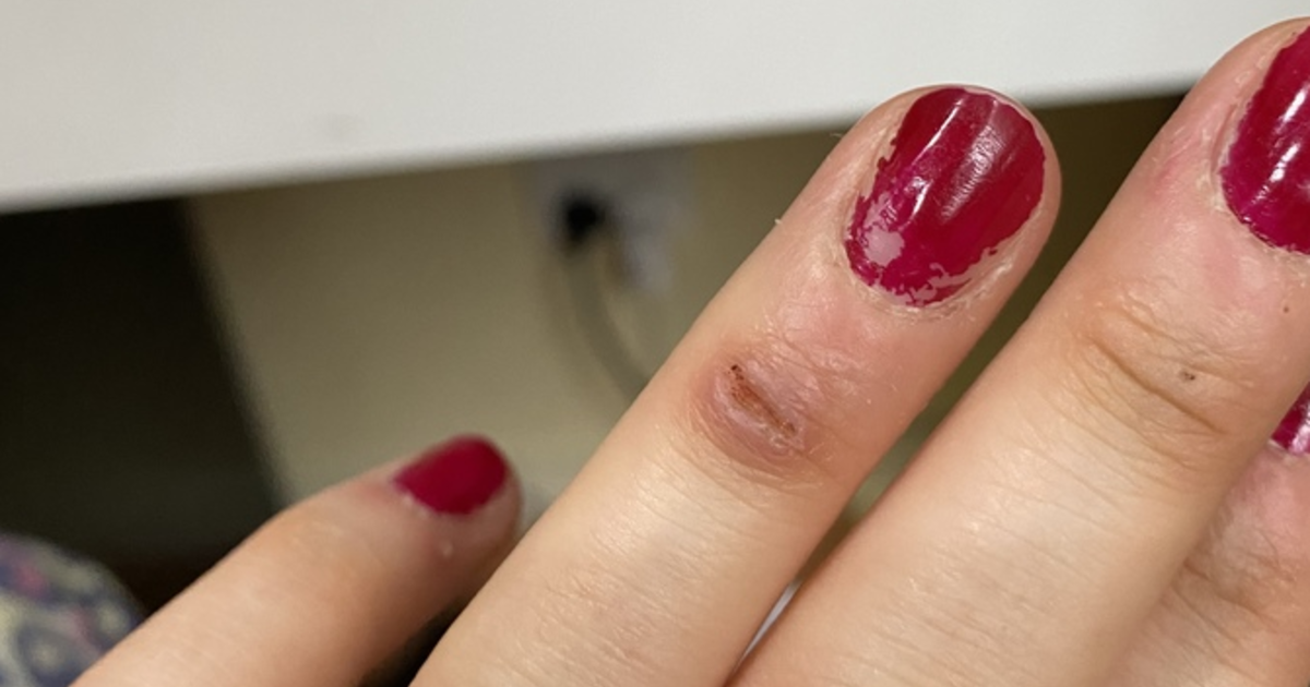 Does this cut look infected? - GirlsAskGuys