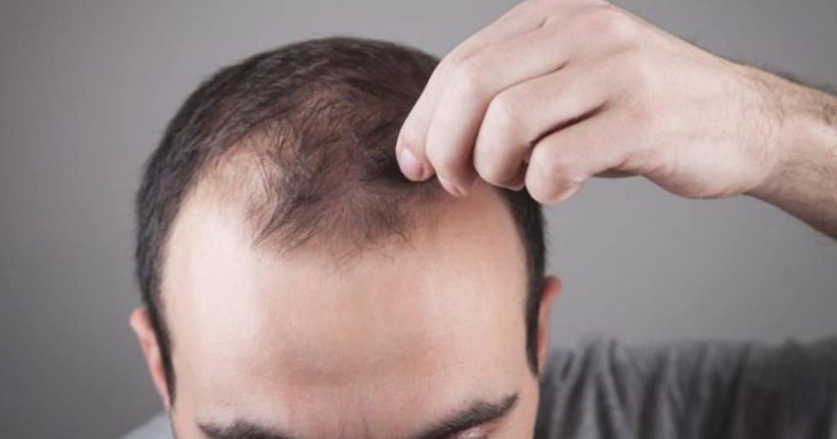 I am going bald at a very young age and I don't how to deal with it ...