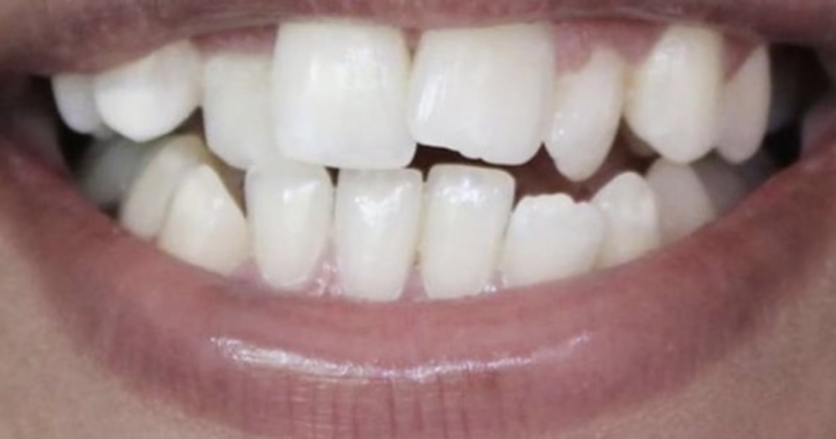 How would you feel about a friend or significant other with teeth ...
