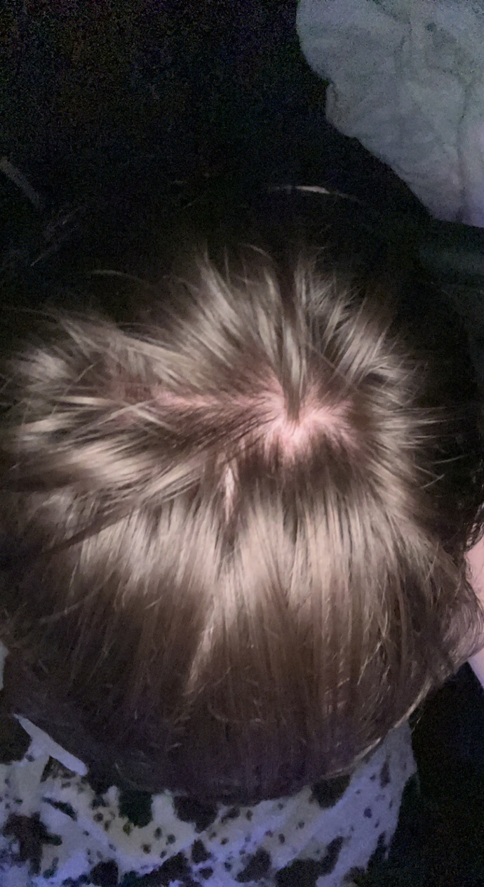 Bald spot or not? - GirlsAskGuys