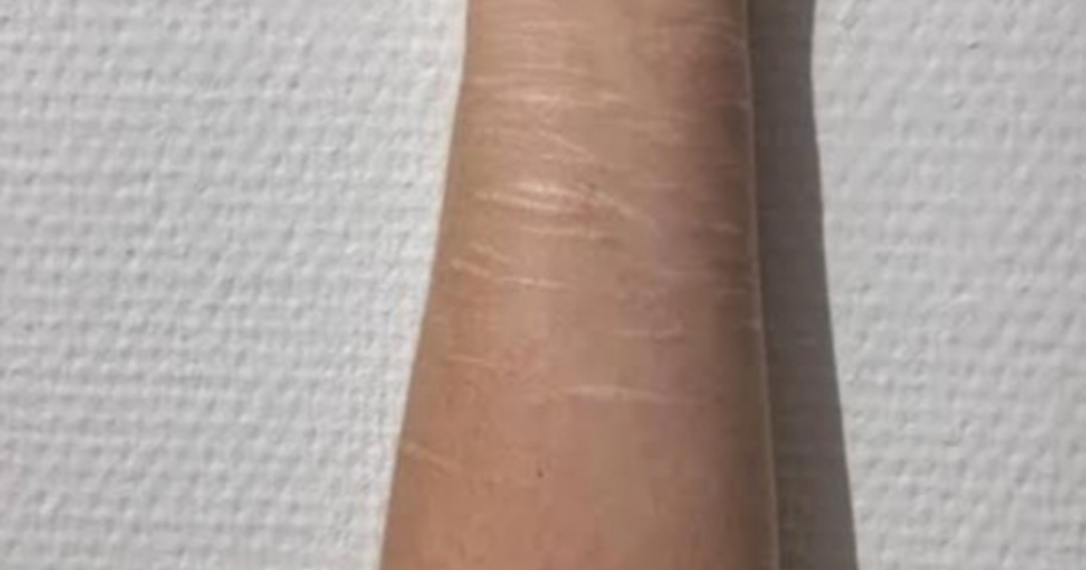 What would you think if you notice a visible self harm scar of a person ...