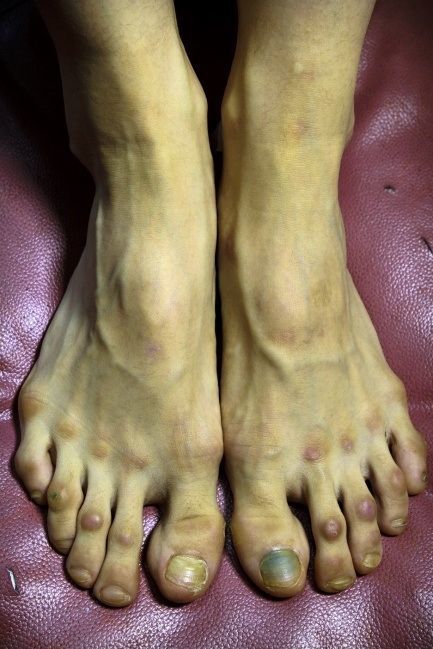 I have weird feet/toes (photo) - Dealbreaker? - GirlsAskGuys