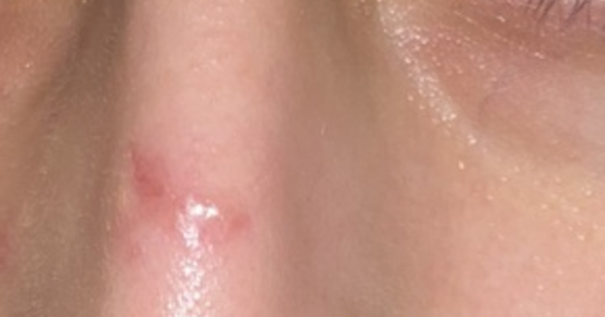 Can I get laser on this cut on my nose (pic) ? - GirlsAskGuys