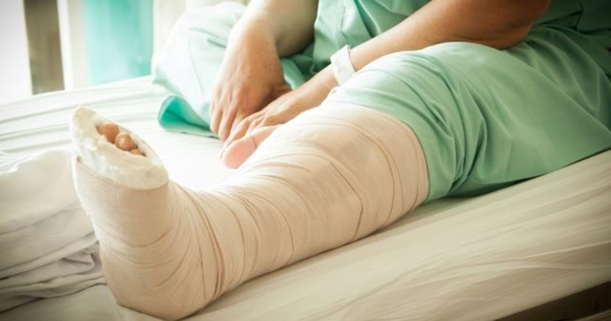 Have you ever broken a limb? How did you manage recovery? - GirlsAskGuys