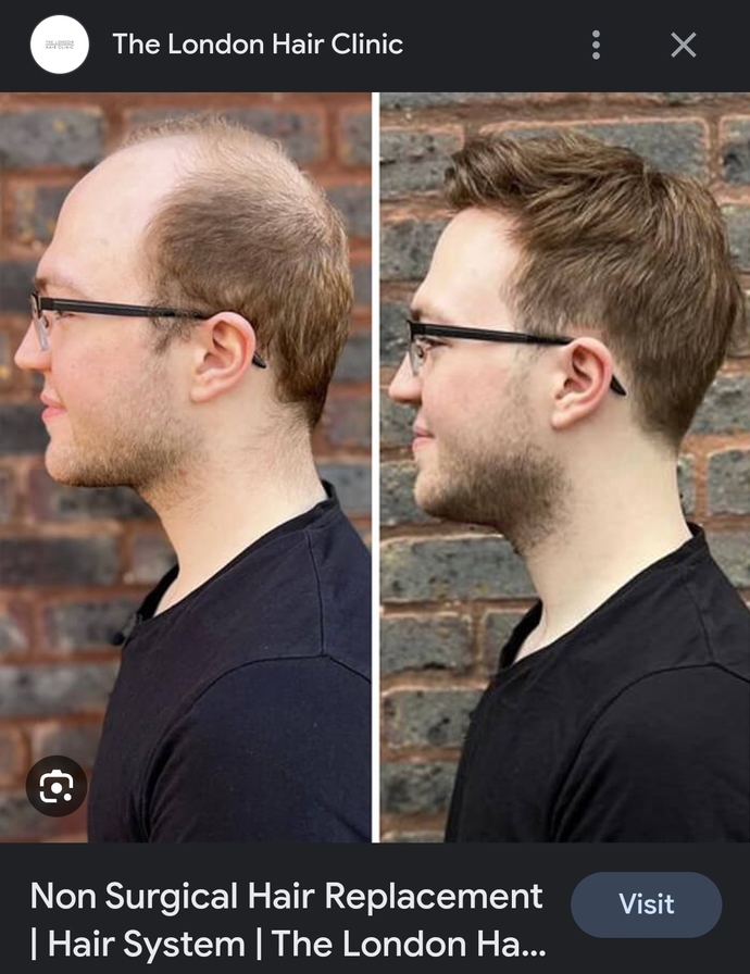 Balding guy at 20, what may I do to compensate for this flaw ...