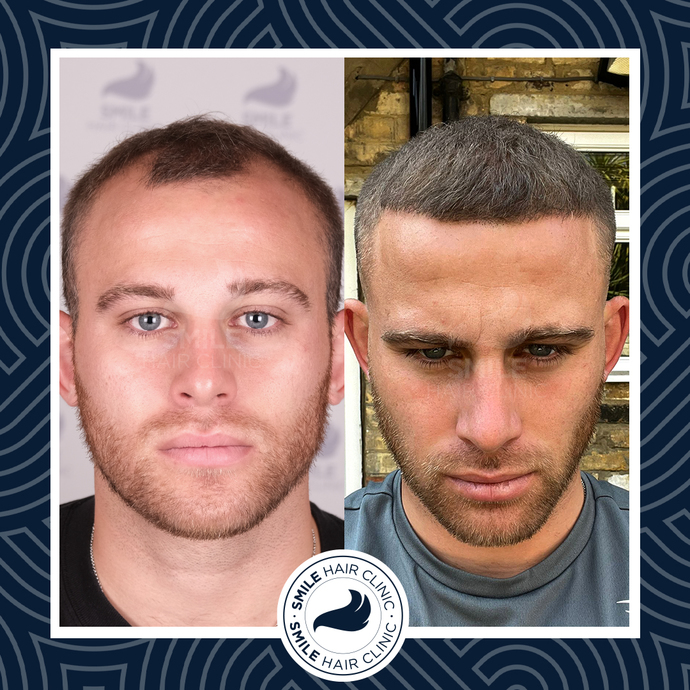 Balding guy at 20, what may I do to compensate for this flaw ...