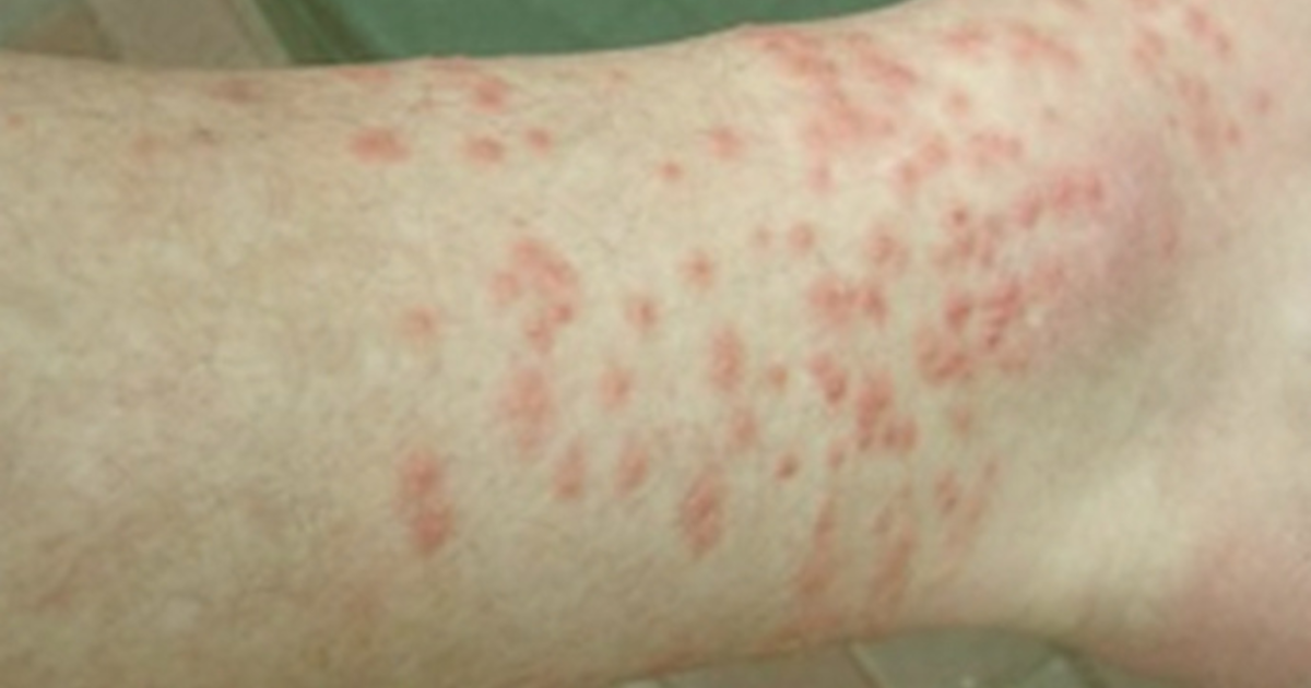 What’s the best treatment for chigger bites? - GirlsAskGuys