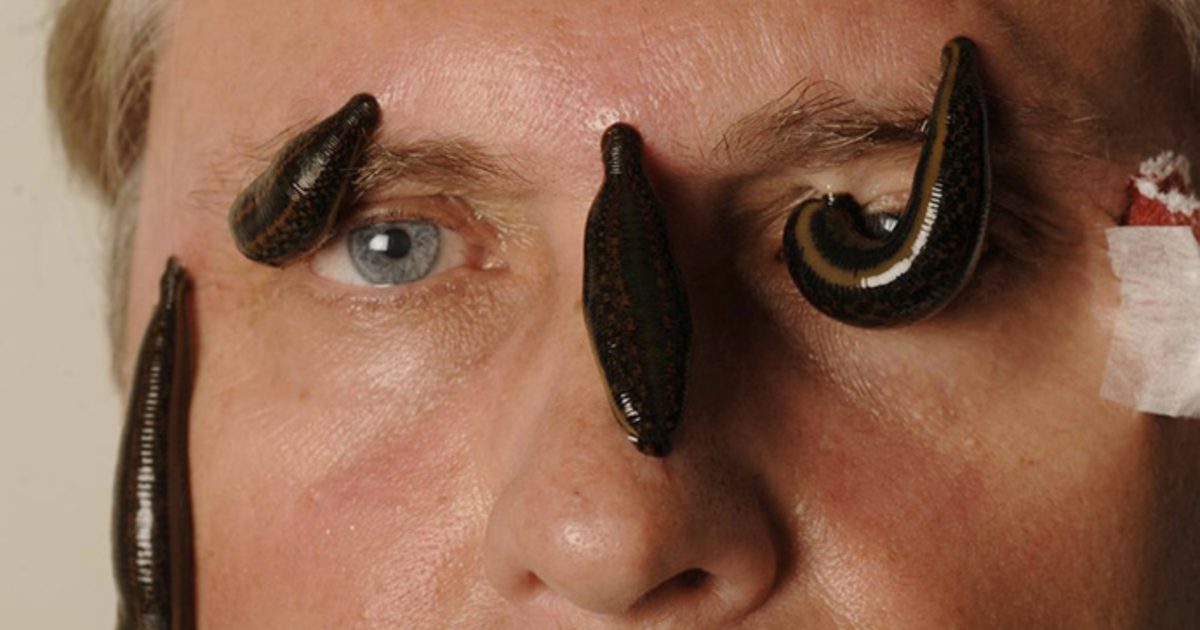 Have you ever had leeches? - GirlsAskGuys