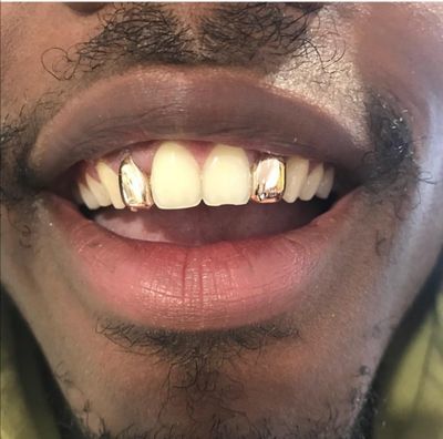 If you were to get a gold tooth cap grill as a style look, which ...