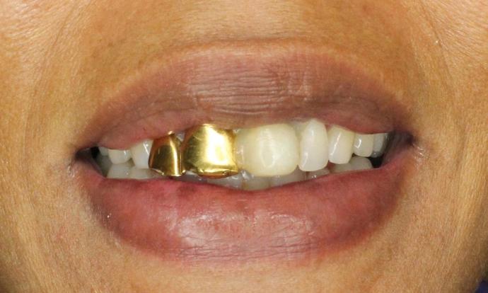 If you were to get a gold tooth cap grill as a style look, which ...