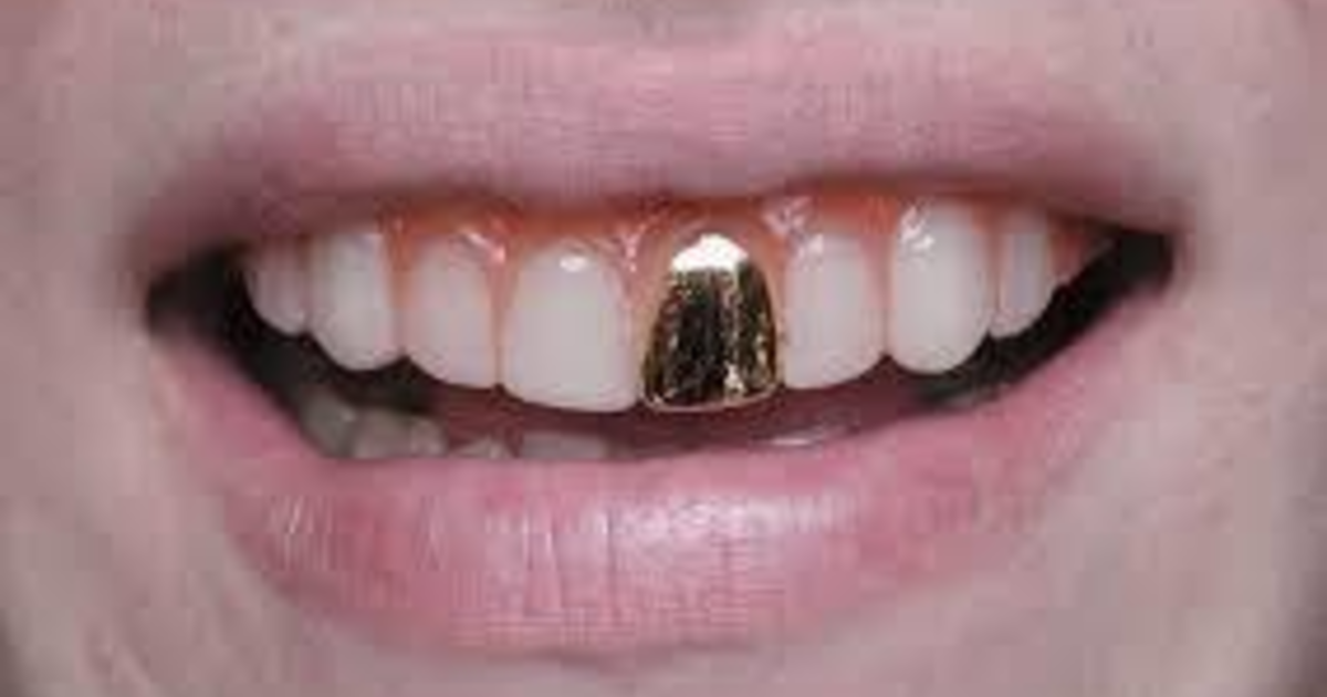 If you were to get a gold tooth cap grill as a style look, which ...