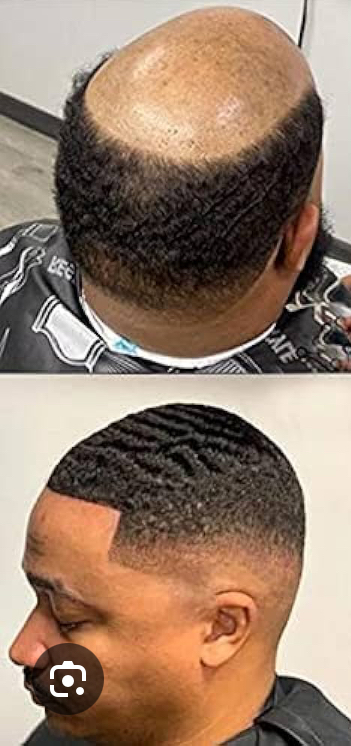 I’m not attracted to bald man and my husband is balding. How can I ...