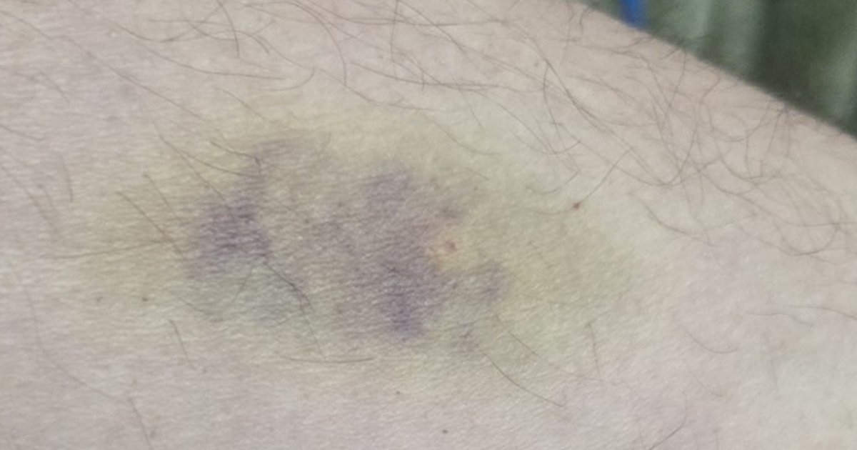 Ever been a combative patient? Restrainer? Witness? Tech did their best ...